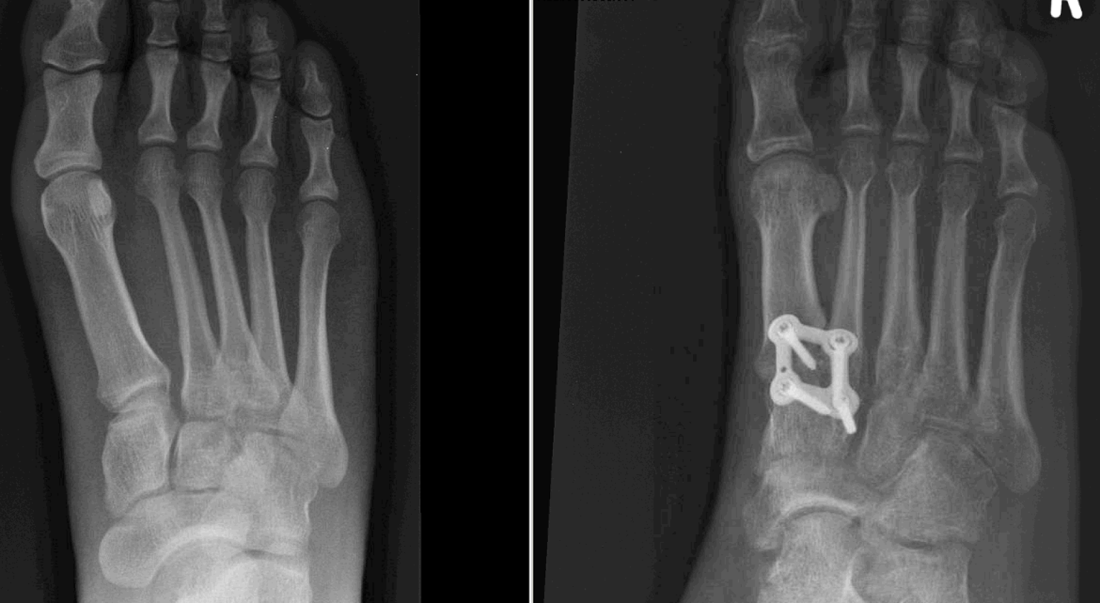 www.lisfranc.ca - Lisfranc Fracture / Injury Blog: Lisfranc / Midfoot ...