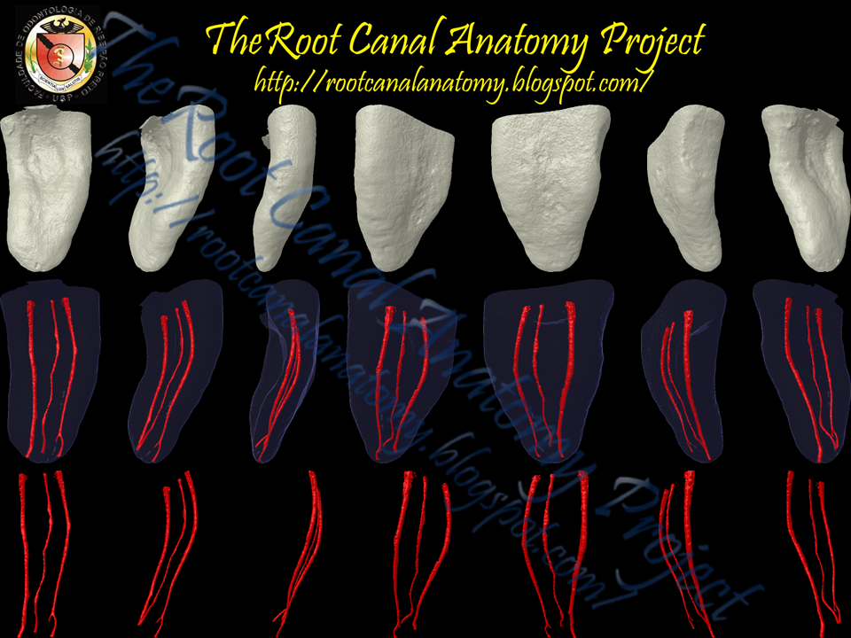 The Root Canal Anatomy Project: Middle Mesial Canal: Mandibular First Molar