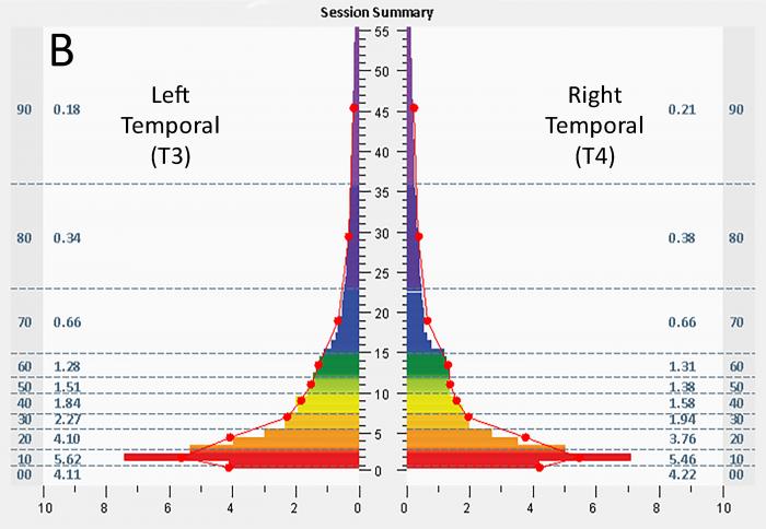 Our Parkinson's Place: Innovative sound therapy treats hypertension and ...
