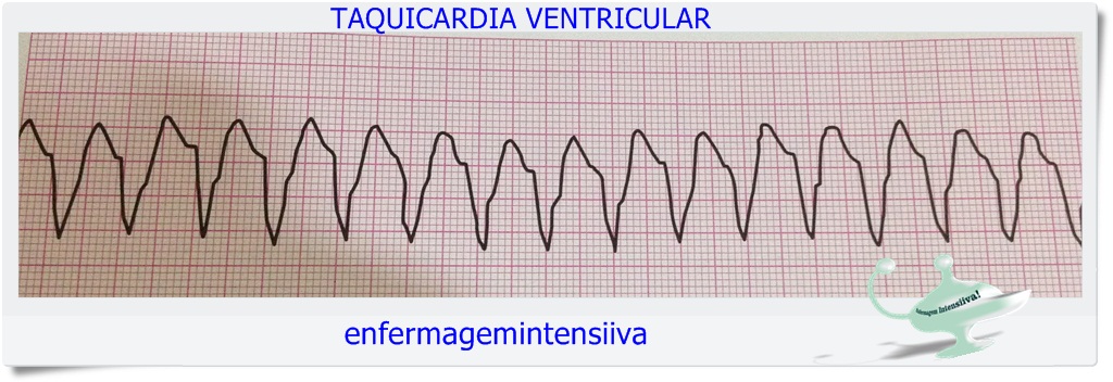 Enfermagem atualizada...: TAQUICARDIA VENTRICULAR