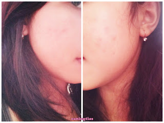 [ACNE FIGHT] Dua Bulan Melawan Jerawat dengan Tretinoin 0,05 Reticor ...