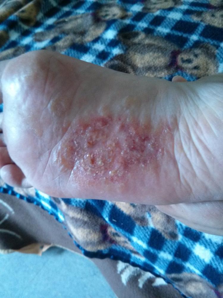 Living With Dyshidrosis/Pompholyx: How my dyshidrosis began