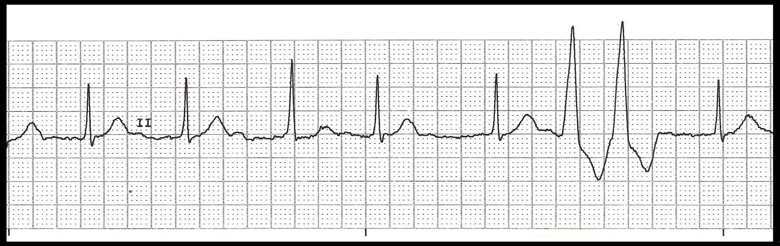 EKG Quiz 324