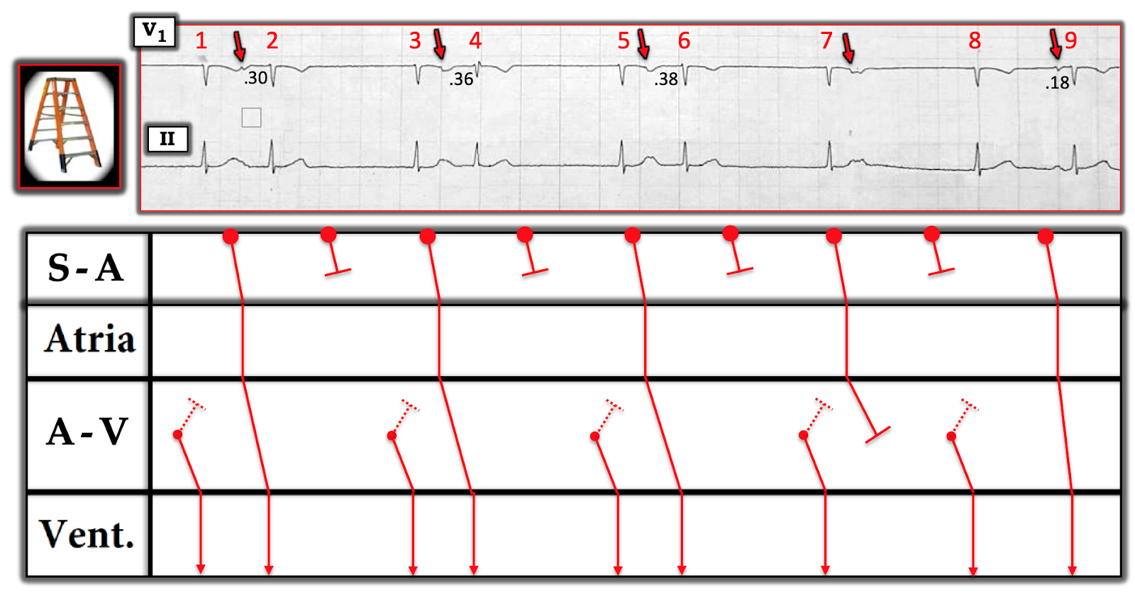 ECG Interpretation: ECG Blog #163 (Escape-Capture - Wenckebach - SA Block)