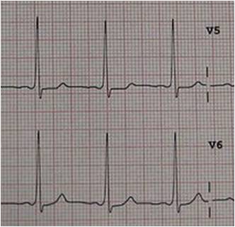 My USMLE CK Mental Map: Paroxysmal supraventricular tachycardia
