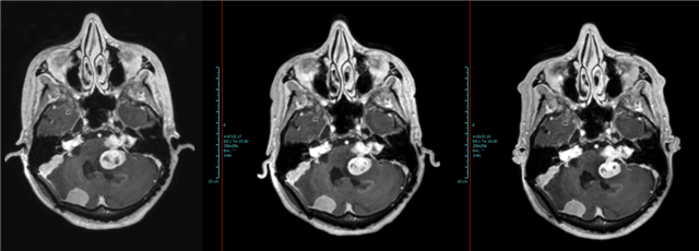 NF2 odyssey: When "brain moles" get busy