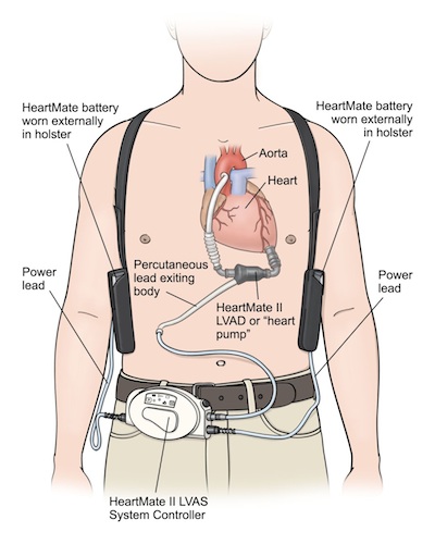 LVAD for the Nephrologist-Part 1 - Renal Fellow Network