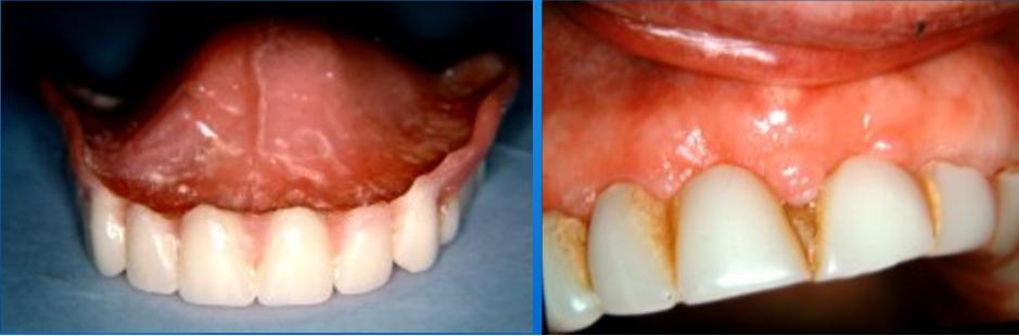 Dentistry lectures for MFDS/MJDF/NBDE/ORE: DENTURE FRACTURE & REPAIR ...