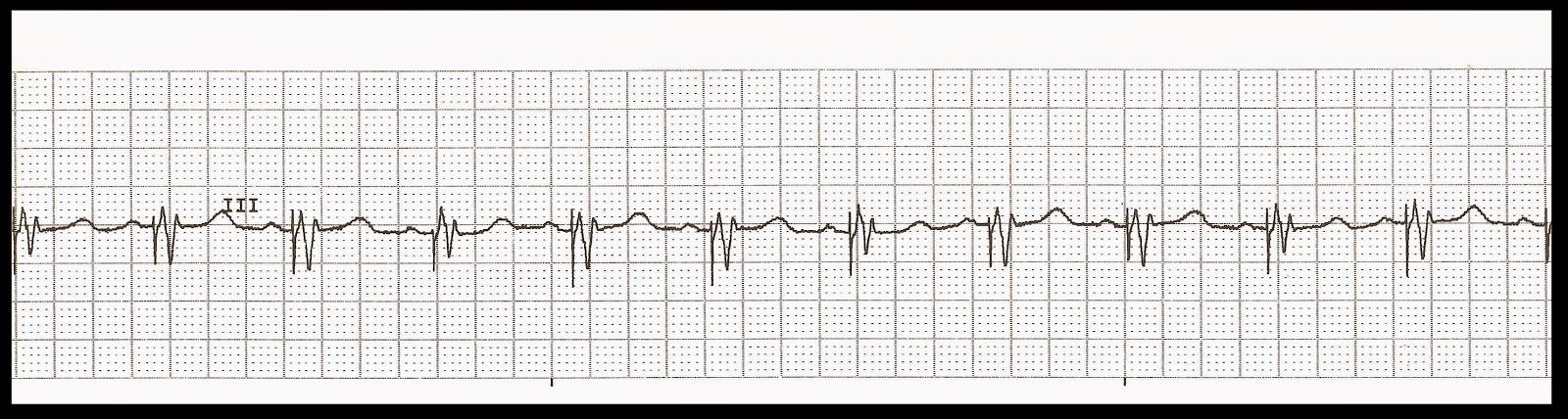 Various Ventricular Paced Rhythms