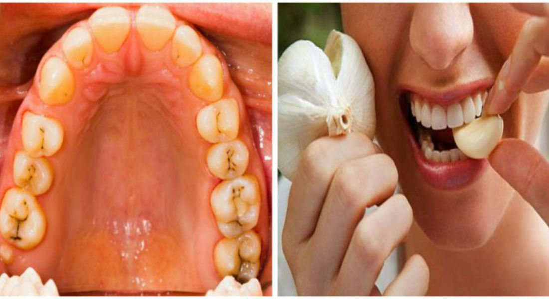 Reverse Tooth Decay and Heal Cavities With These Powerful Home Remedies ...