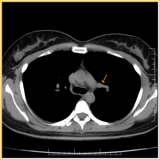 Partial Anomalous Left Upper Lobe Pulmonary Venous Drainage - Sumer's ...