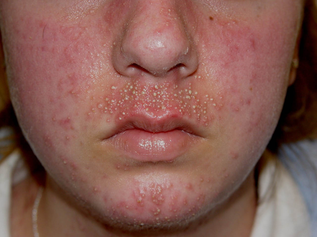 Five Causes Of Acne Cysts - ForHealth Blog - How to keep you healthy ...
