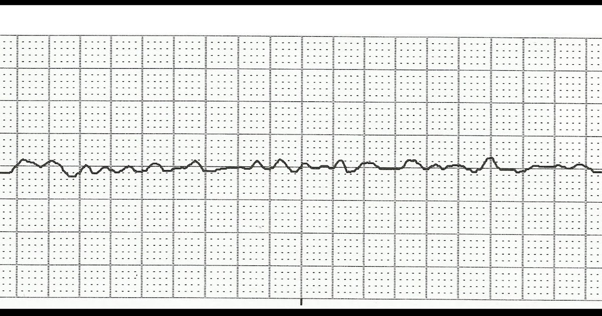 Basic Rhythm Test 26