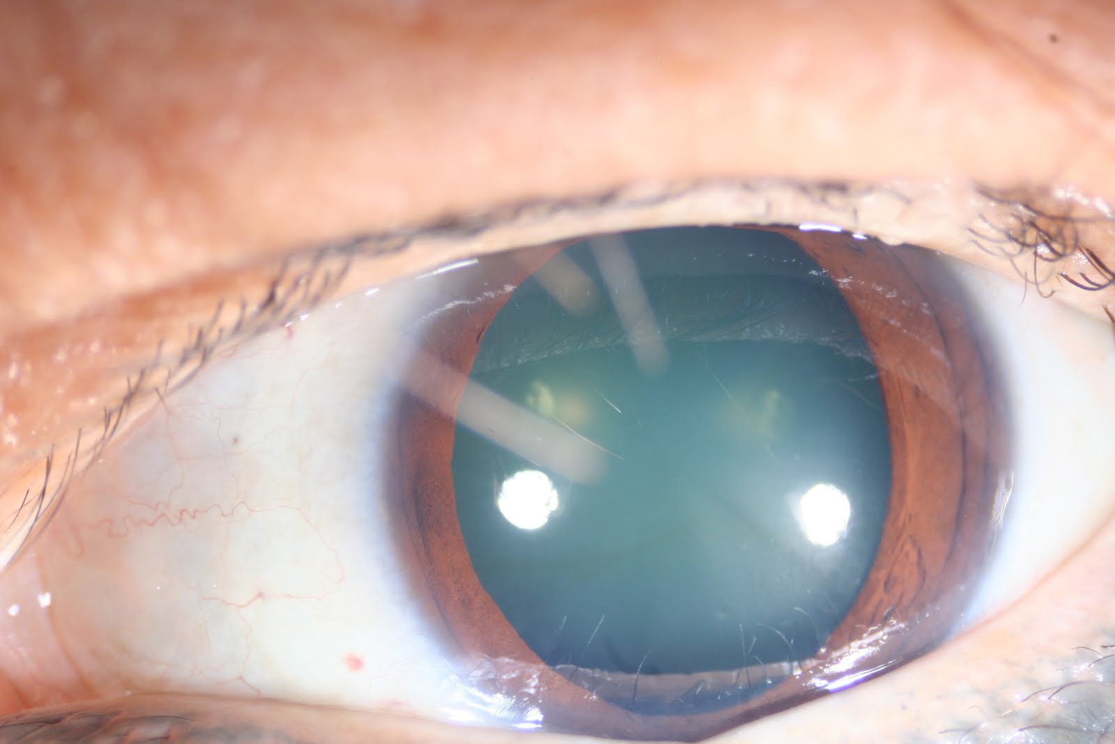 Modern & Multidimensional Iridology: Bilateral Mydriasis - (shk)