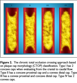 Vascular Mind : CHRONIC TOTAL OCCLUSION CROSSING APPROACH BASED ON ...
