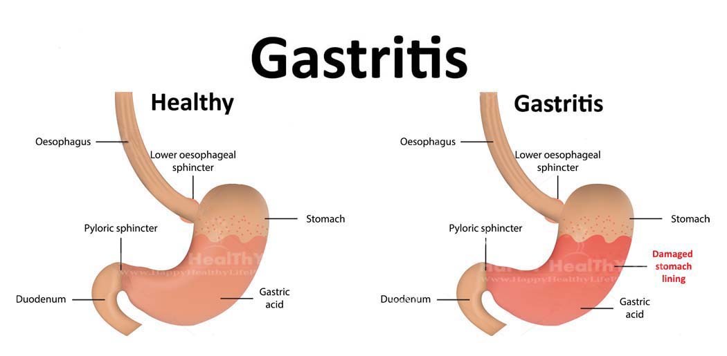 .: Cara Atasi Gastrik Dengan Semulajadi