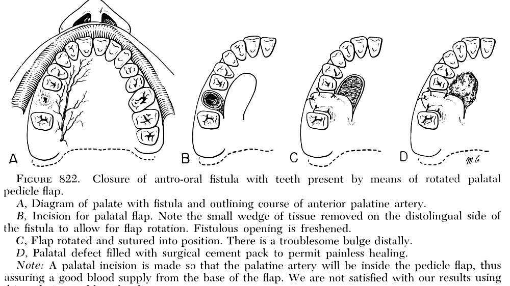 Oroantral fistula