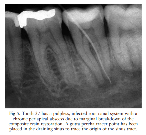 Endodontic: Periapical diseases