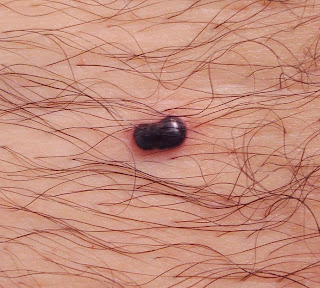 VIRTUAL GRAND ROUNDS IN DERMATOLOGY 2.0: Hemorrhagic Blister