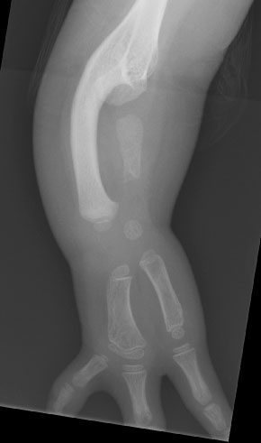 Ulnar deficiency, considerations for surgery | Congenital Hand and Arm ...