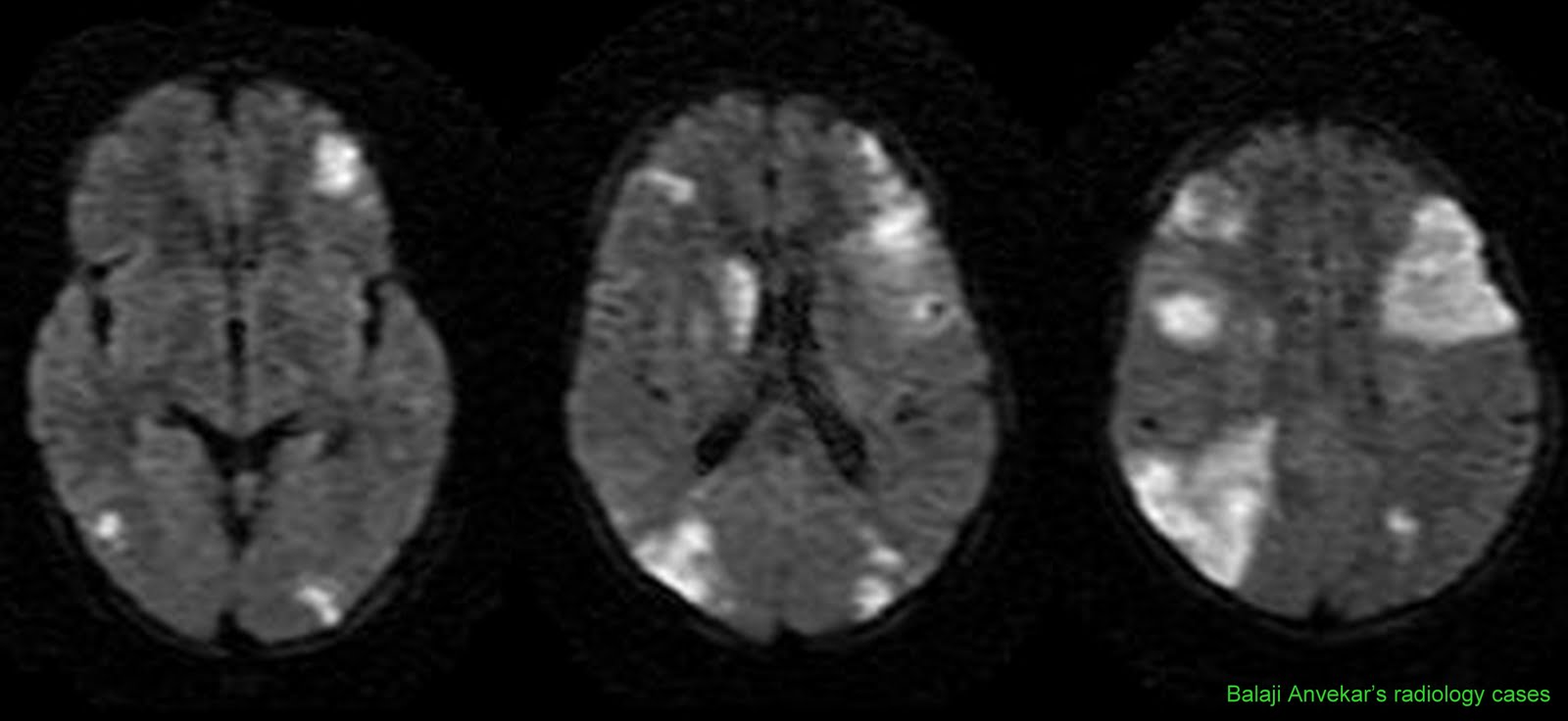 Dr Balaji Anvekar FRCR: Bilateral Border Zone Infarctions