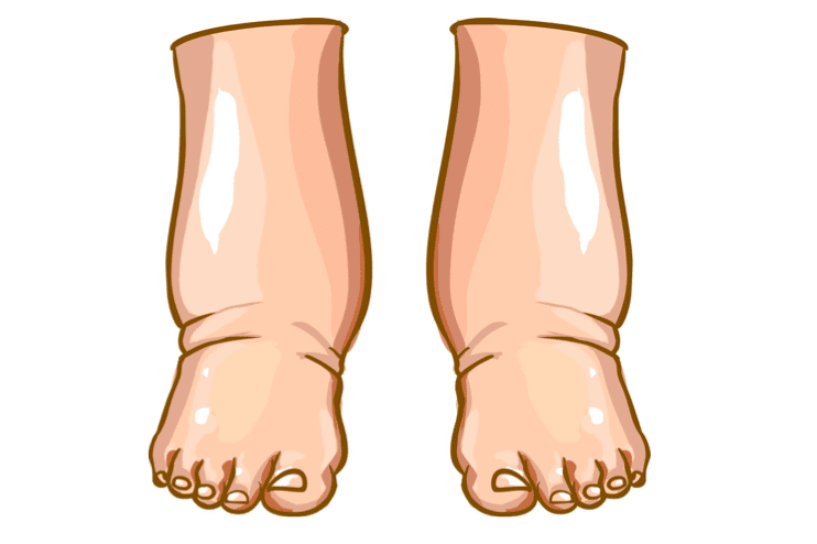 o tratamento da doença renal: Como a síndrome nefrótica leva ao edema?