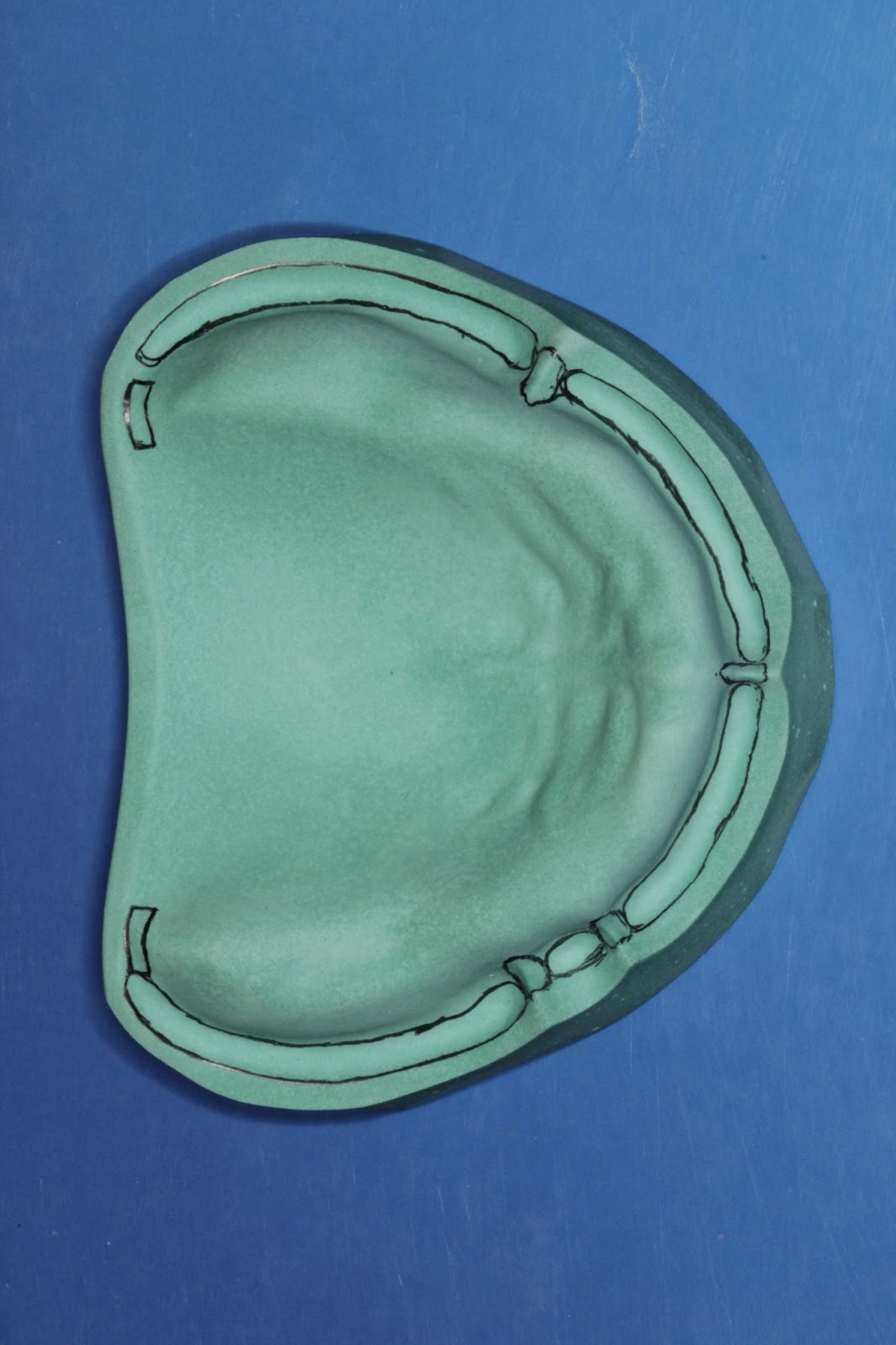 Understanding Prosthodontics - Tagore Dental College & Hospital-By ...