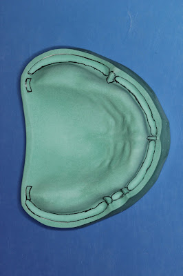 Understanding Prosthodontics - Tagore Dental College & Hospital-By ...