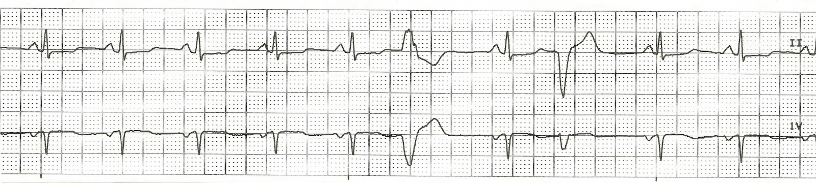 EKG Rhythm Strip Quiz 76
