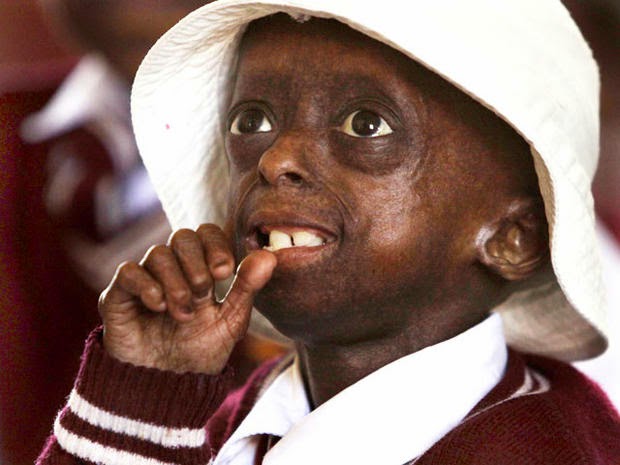 PROGERIA , Hutchinson-Gilford Progeria Syndrome or "HGPS" ~ Dr Impo