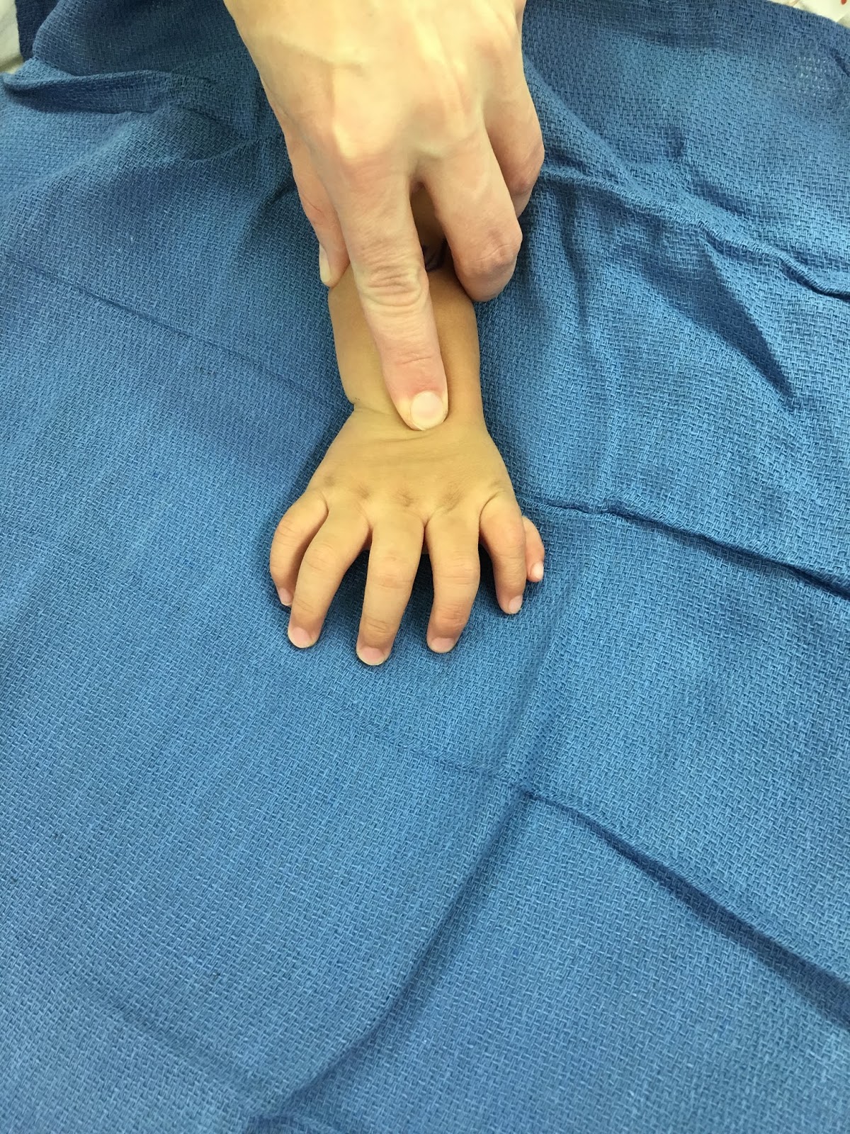 The 5 Finger Hand | Congenital Hand and Arm Differences | Washington ...