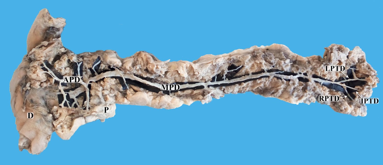 Bifid pancreas tail and superior horizontal pancreatic artery of Popova ...