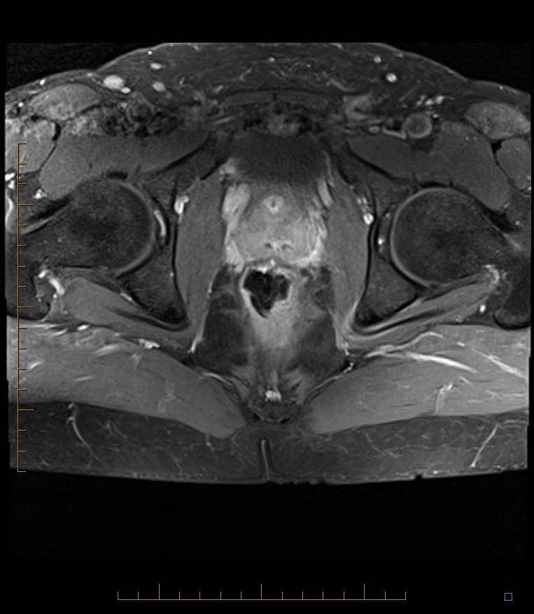 Radiology Cases: Left Pudendal Neuralgia in Cyclist