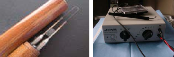 Kumpulan Kasus Medis: Sirkumsisi metode konvensional dan smart klamp