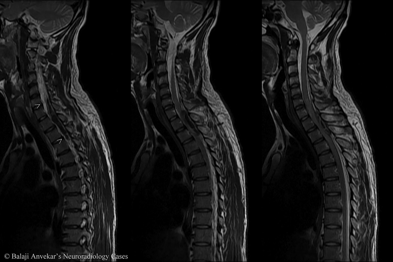 Dr Balaji Anvekar FRCR: Spinal Epidural Hematoma MRI