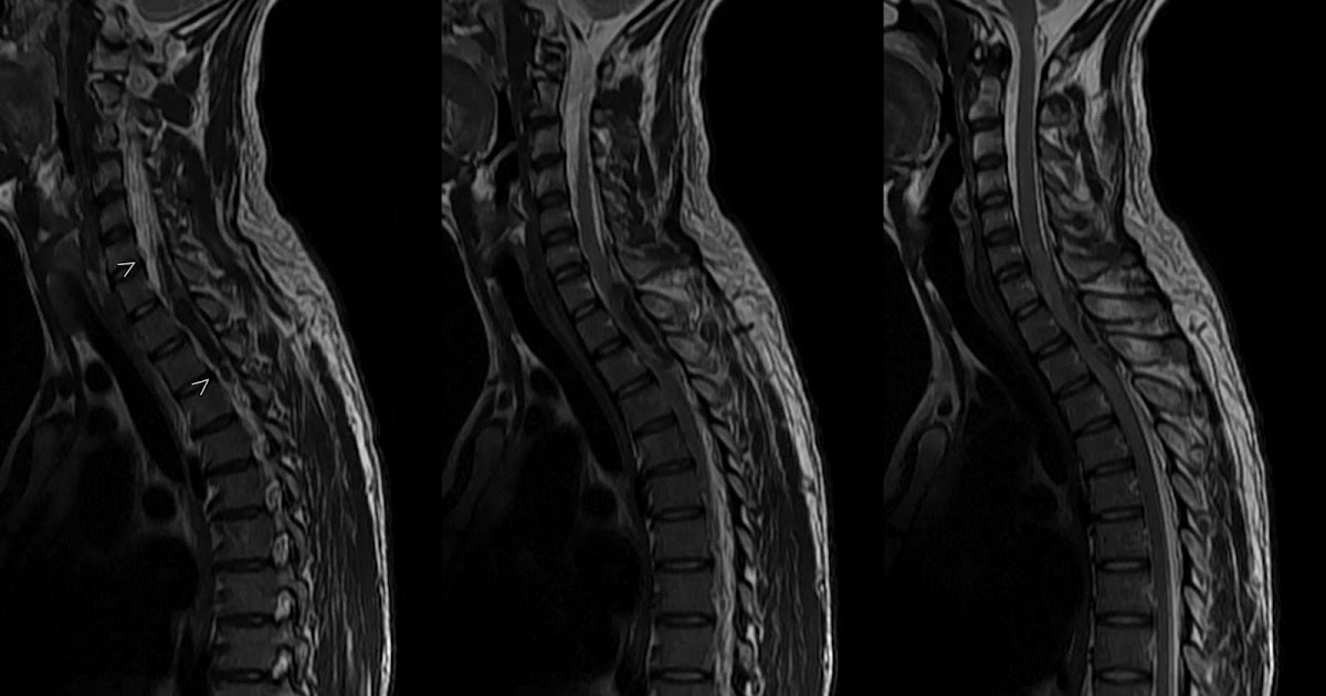 Neuroradiology Cases: Spinal Epidural Hematoma MRI
