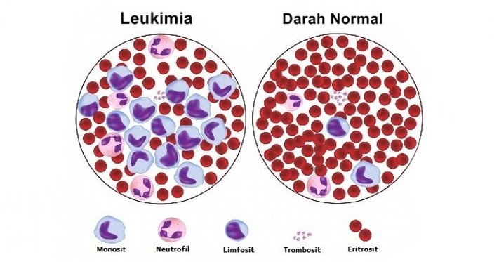 10 Gejala Leukimia yang Sering Diketahui - Obat Sakit 2011