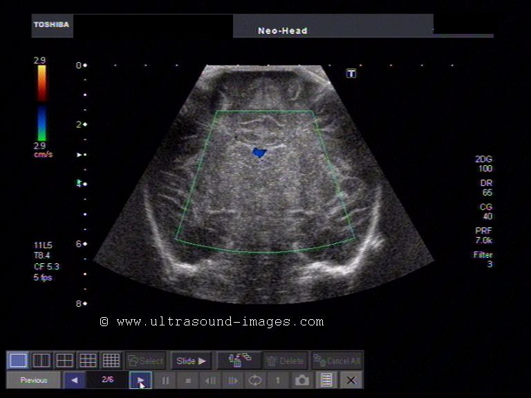 cochinblogs: Cerebral edema in neonates