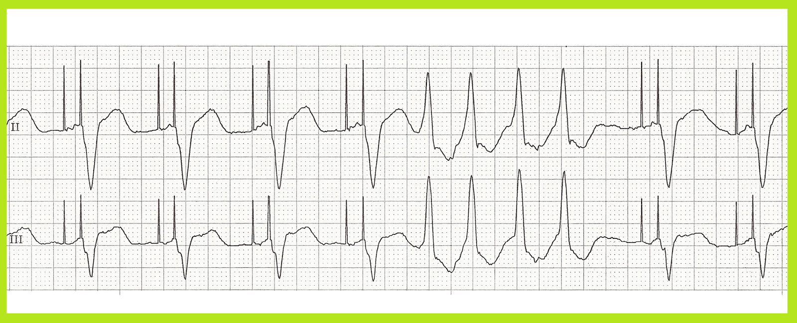 EKG Rhythm Quiz 247