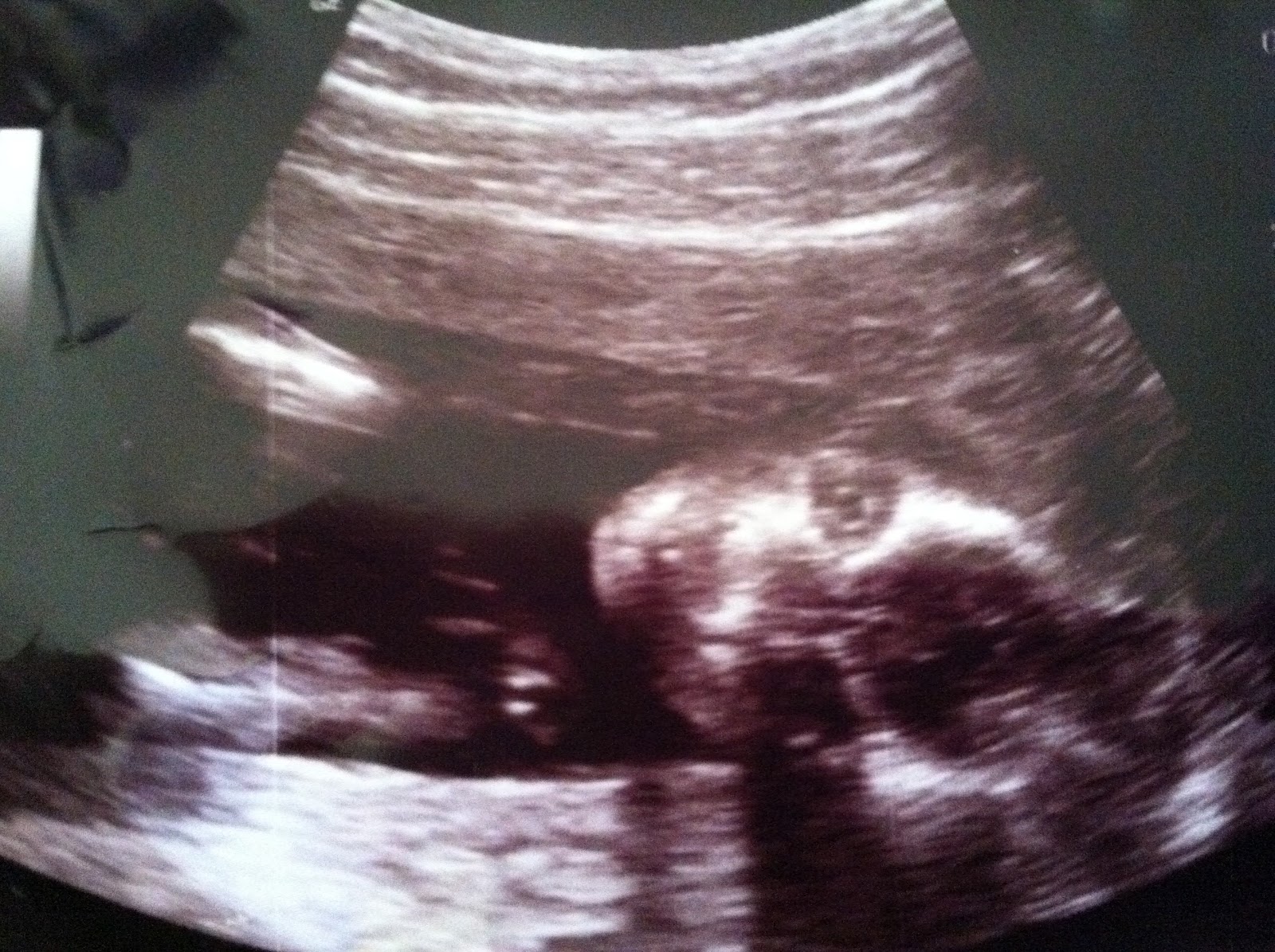 We're Having a Baby!: 18 Week Ultrasound Pictures
