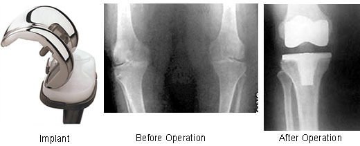 Joint Replacement Surgery in India: Knee Joint Replacement Surgery and ...