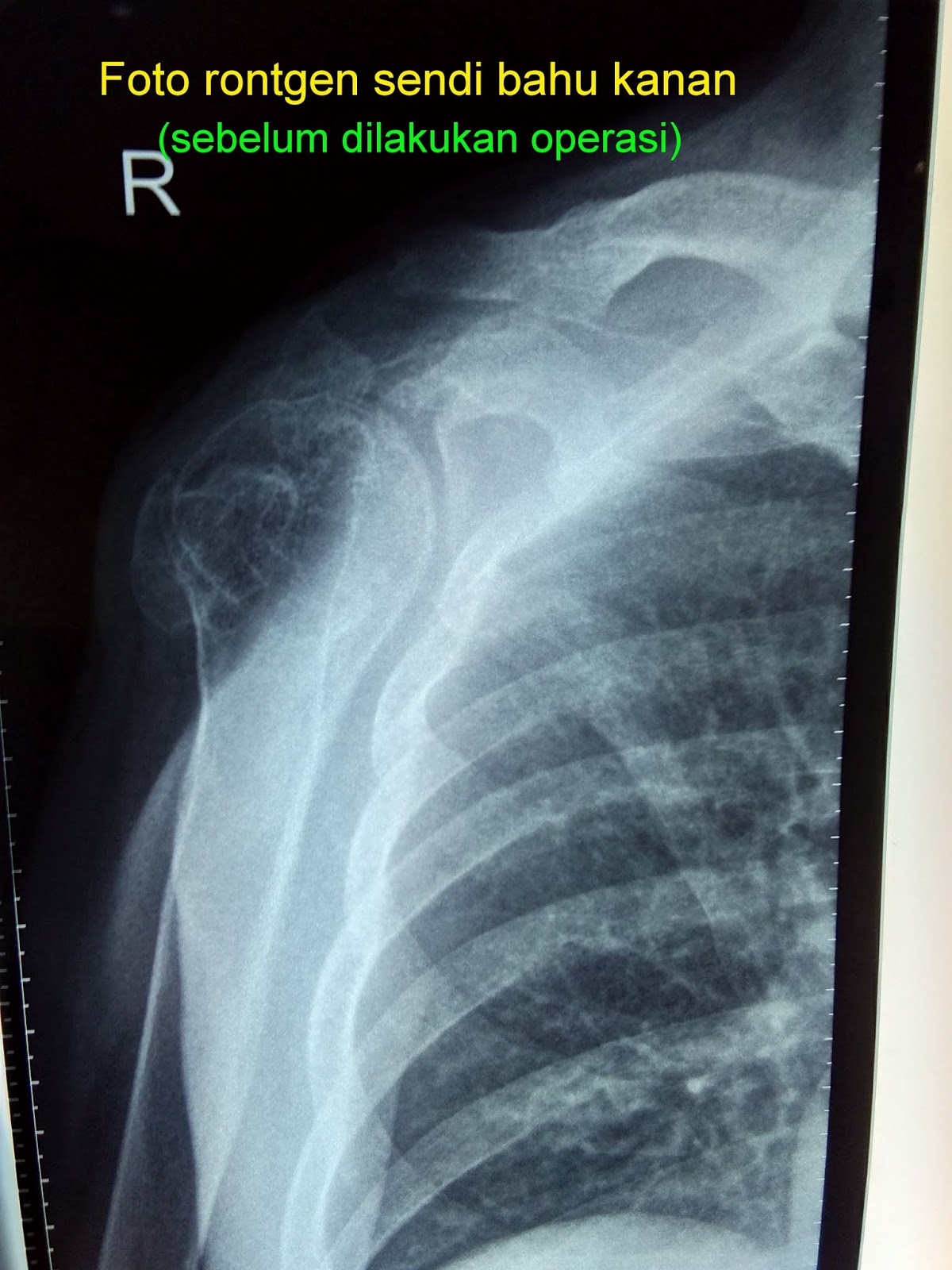 Operasi Menyatukan Sendi Bahu ~ Sendi, Tulang, Otot dan Tulang Belakang