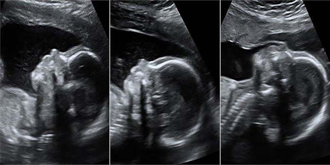 2 plus 3 makes 5!: Morphology Scan