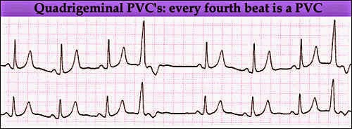 Premature Ventricular Contraction / Ventrikular Ekstrasistol | INA - ECG