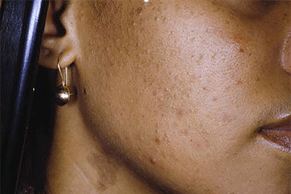 Facial Skin Diseases and Flaws - Afro9jaland