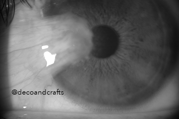 CARNOSIDAD EN EL OJO, CAUSAS DEL PTERIGION