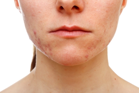 The Science behind Adult Acne and What Steps to Take | Beauty and ...