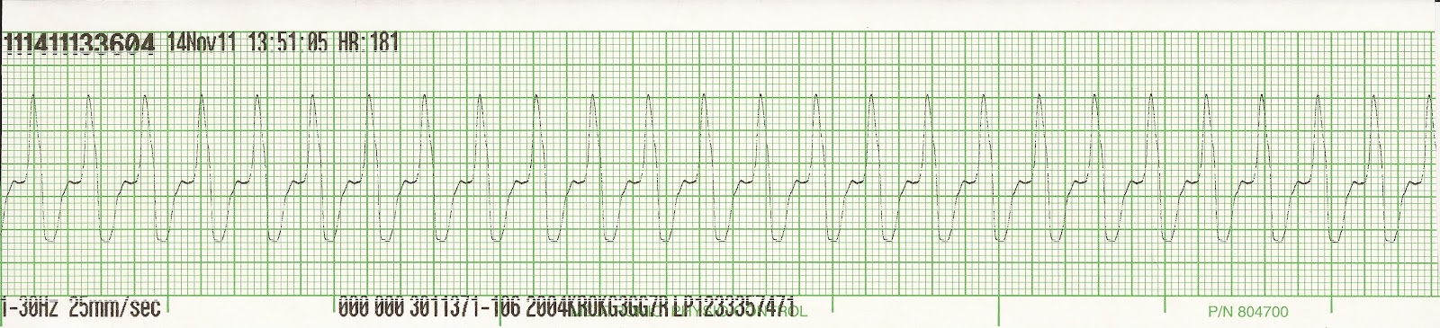 Identify the appropriate electrical intervention for the following EKG ...