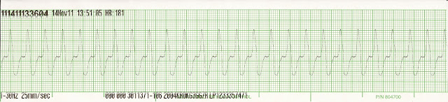 Identify the appropriate electrical intervention for the following EKG ...