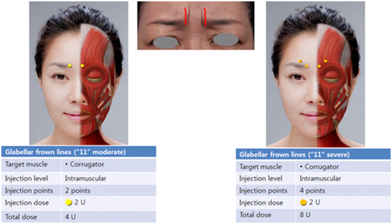 BOTOX EN ENTRECEJO: CÓMO CONSEGUIR UN RESULTADO NATURAL